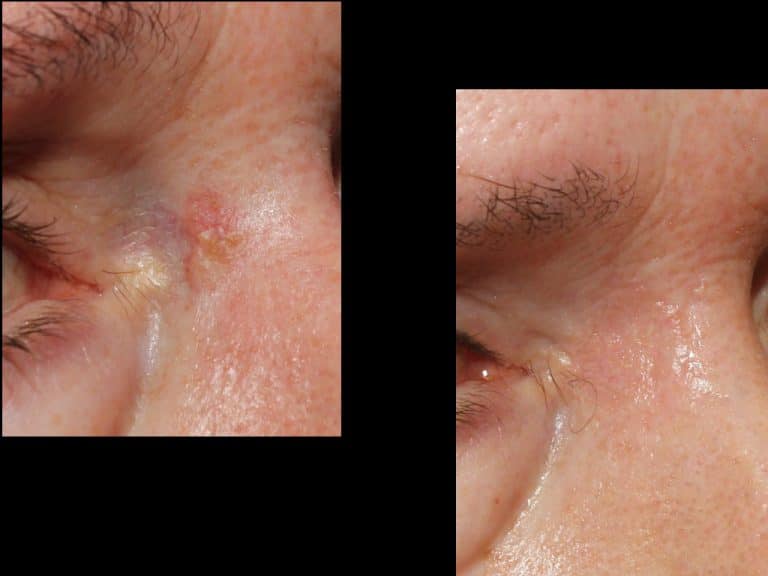 Tumori palpebrali - Basalioma - Dr Migliardi