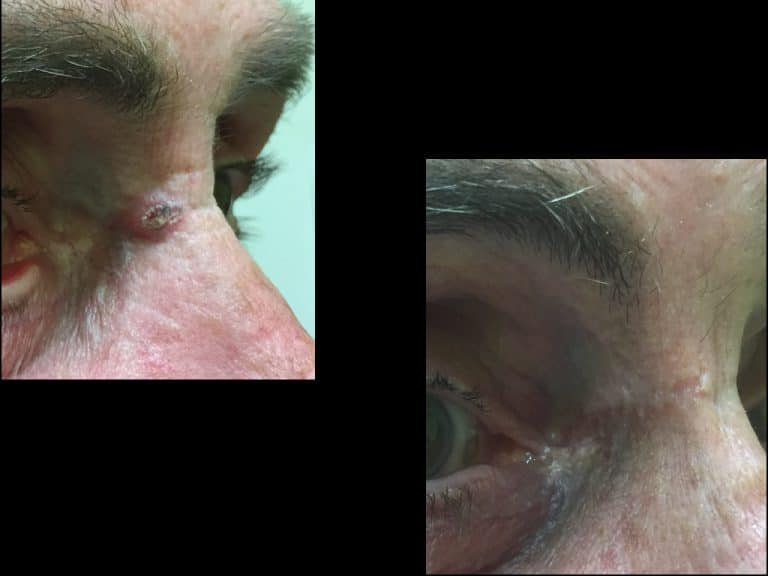 Tumori palpebrali - Basalioma - Dr Migliardi