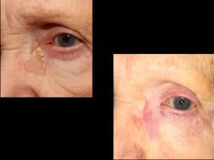 Tumori palpebrali - Basalioma - Dr Migliardi