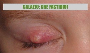 Calazio della Palpebra. Cause, Sintomi e Cure.